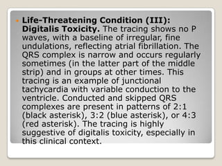 Ecg findings in life threatening conditions | PPTX