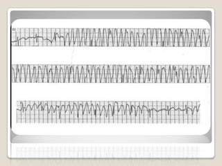 Ecg findings in life threatening conditions | PPTX