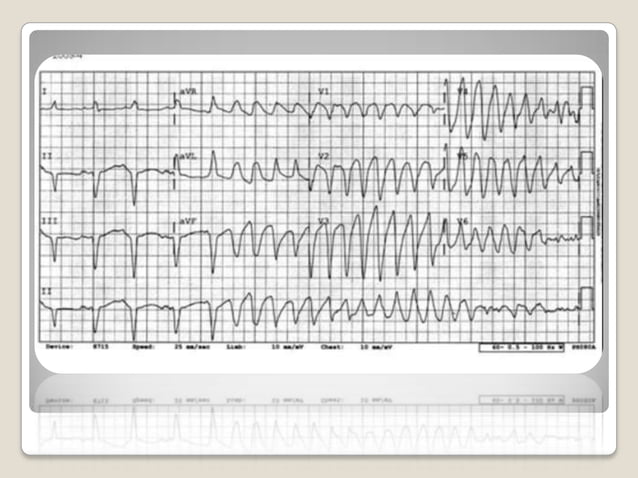 Ecg findings in life threatening conditions | PPTX