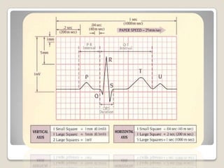 Ecg findings in life threatening conditions | PPTX