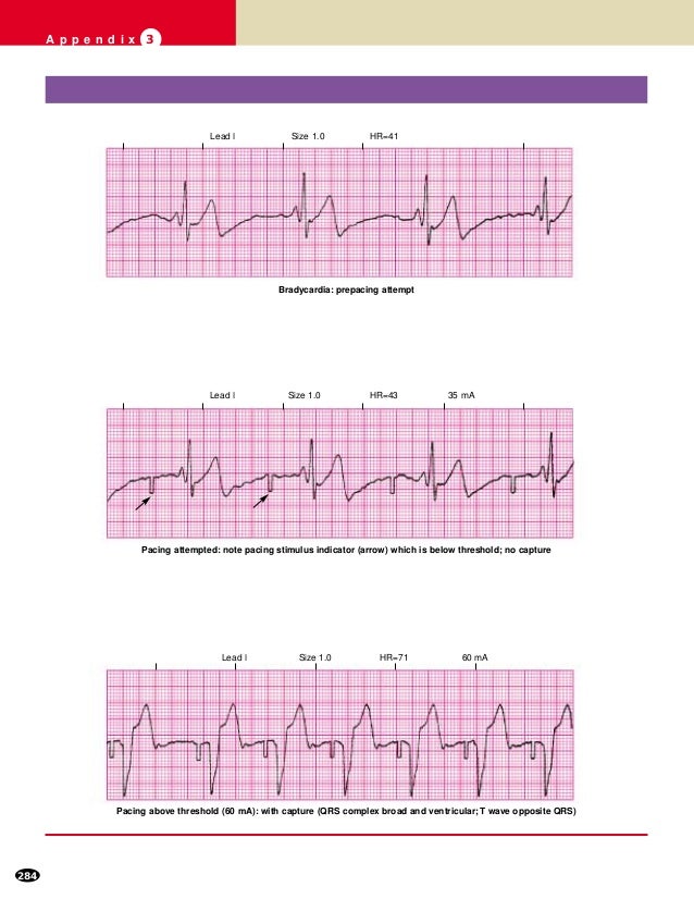 Ecg for acls