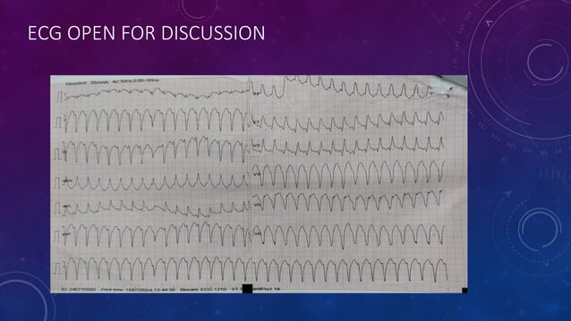 ECG FOR DISCUSSION (Monomorhic VT.).pptx