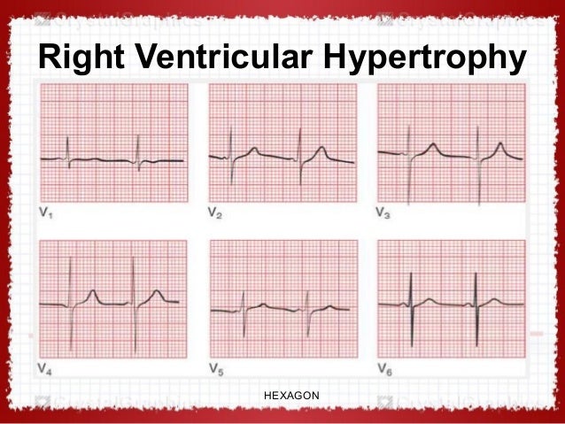 ECG for Final Part 2 WHH