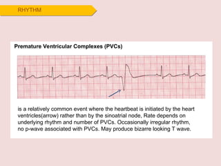 ecg for noob ecg interpretation ecg recall | PPT