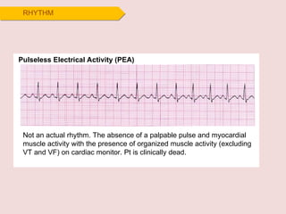 ecg for noob ecg interpretation ecg recall | PPT