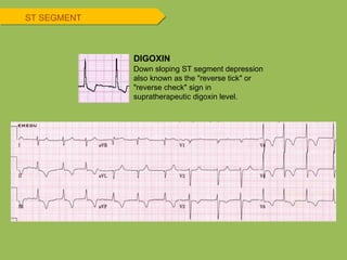 ecg for noob ecg interpretation ecg recall | PPT