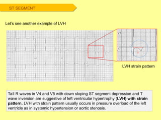 ecg for noob ecg interpretation ecg recall | PPT