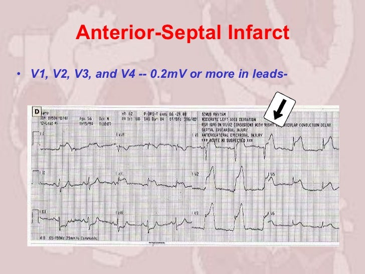 ECG for NPs