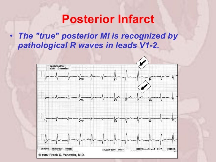 ECG for NPs