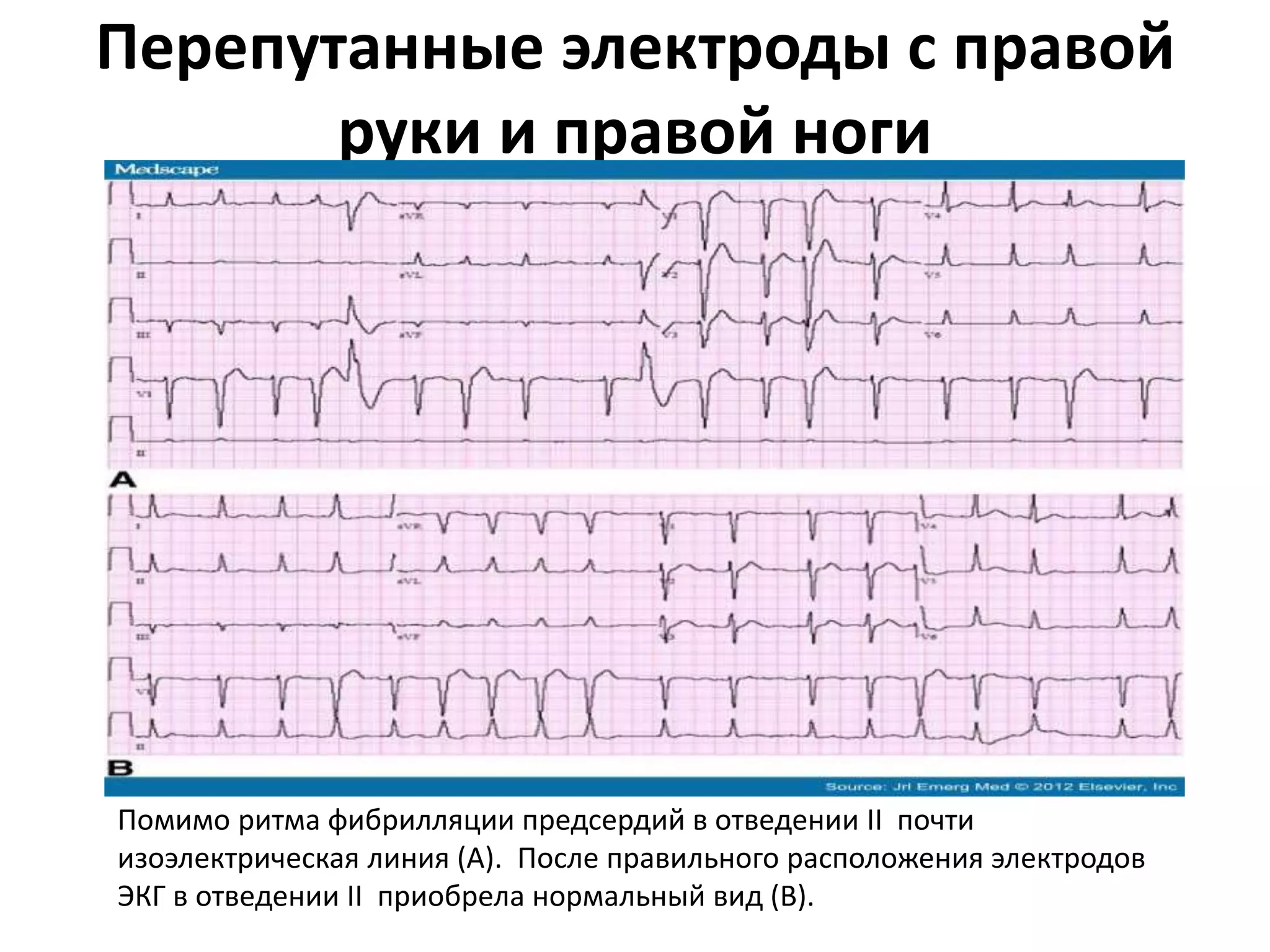 Ecg for nurses | PPTX