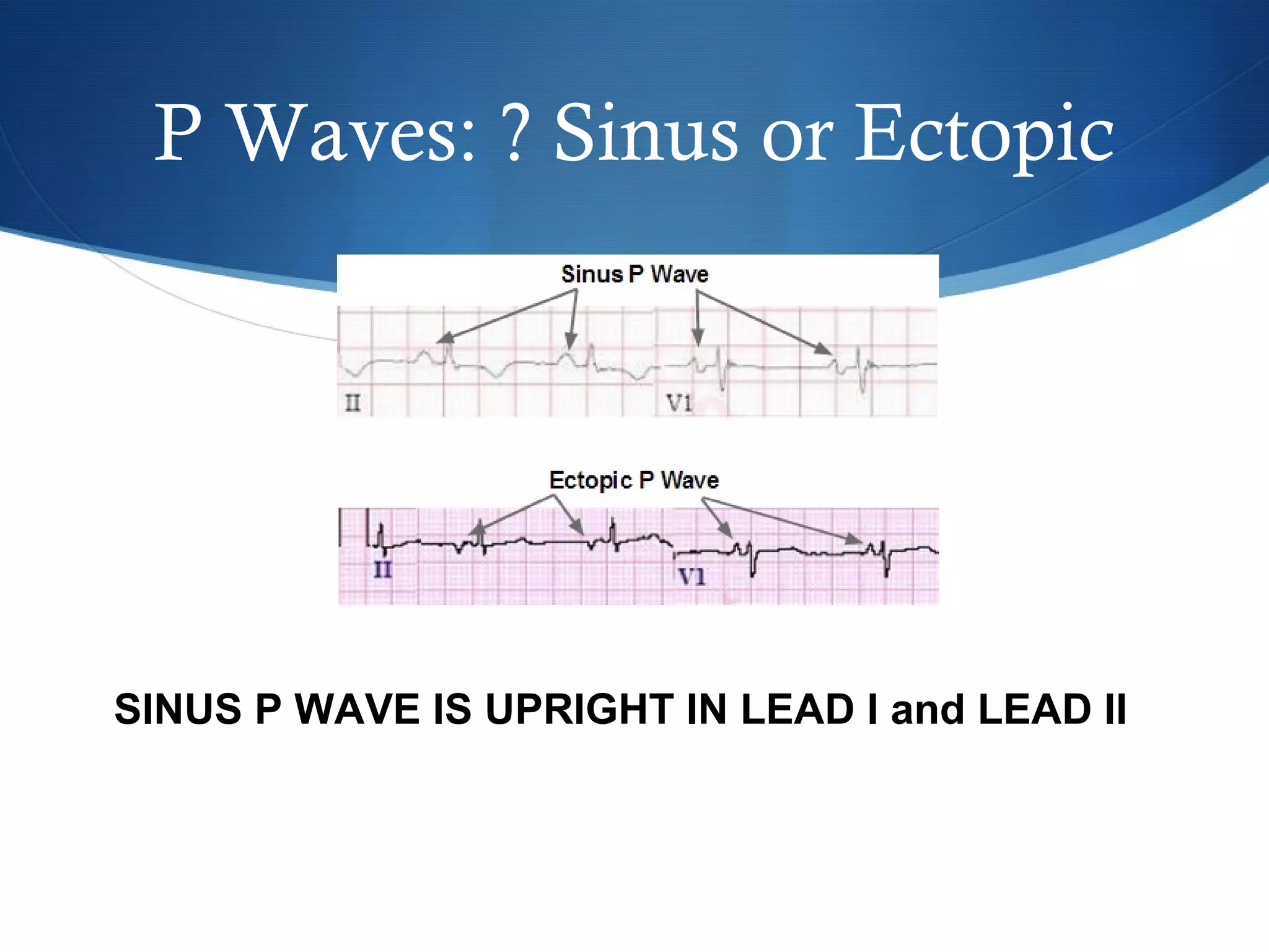 Principles of ECG Interpretation | PPT | Heart and Cardiovascular ...