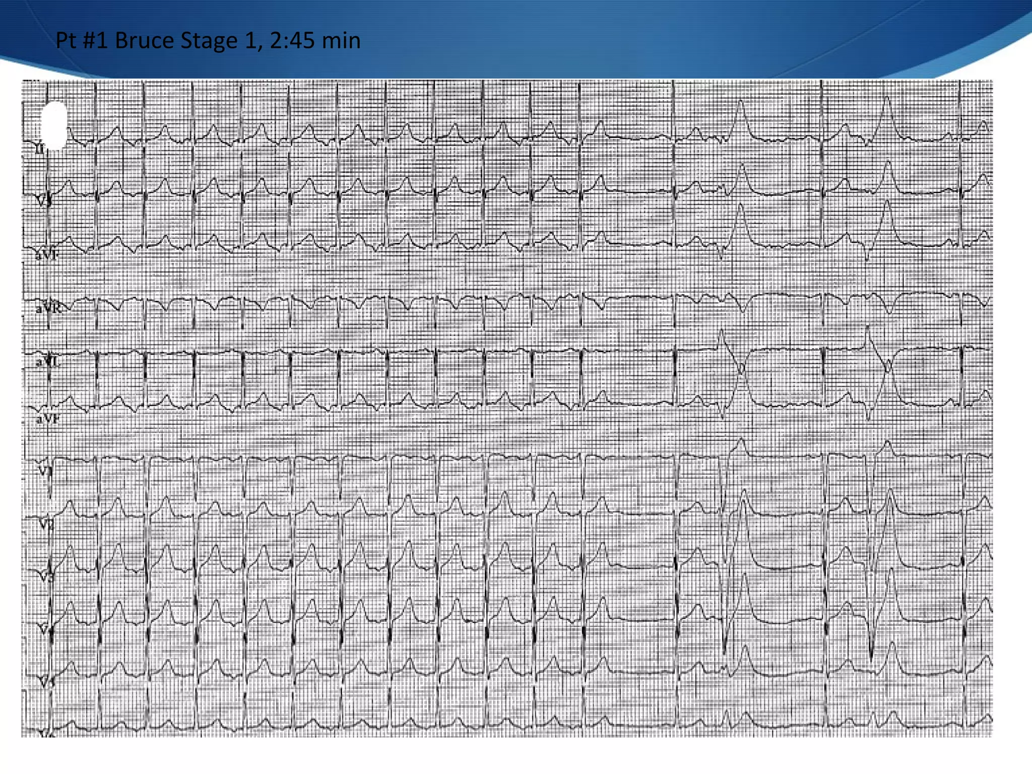 Principles of ECG Interpretation | PPT | Heart and Cardiovascular ...