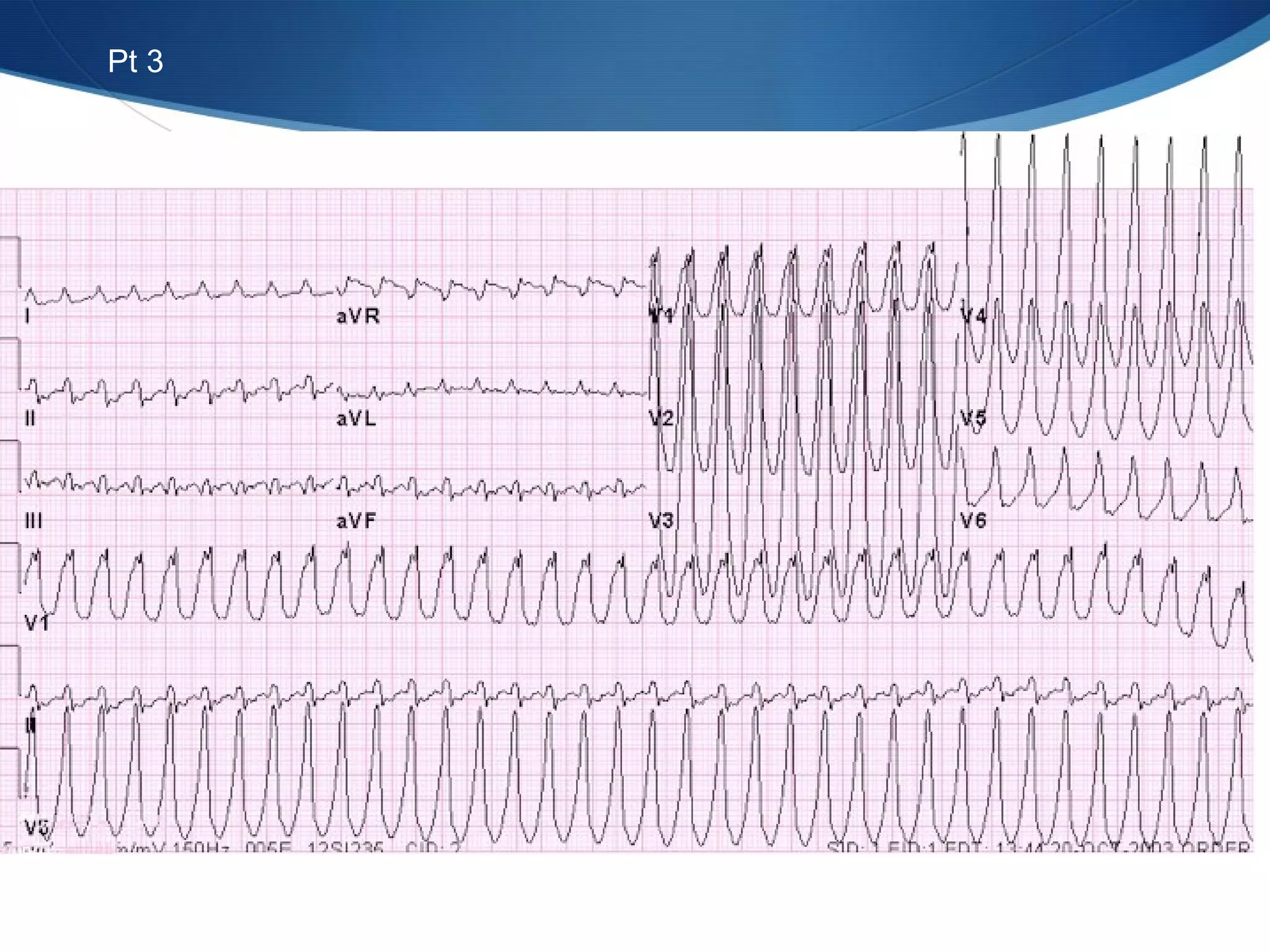Principles of ECG Interpretation | PPT | Heart and Cardiovascular ...