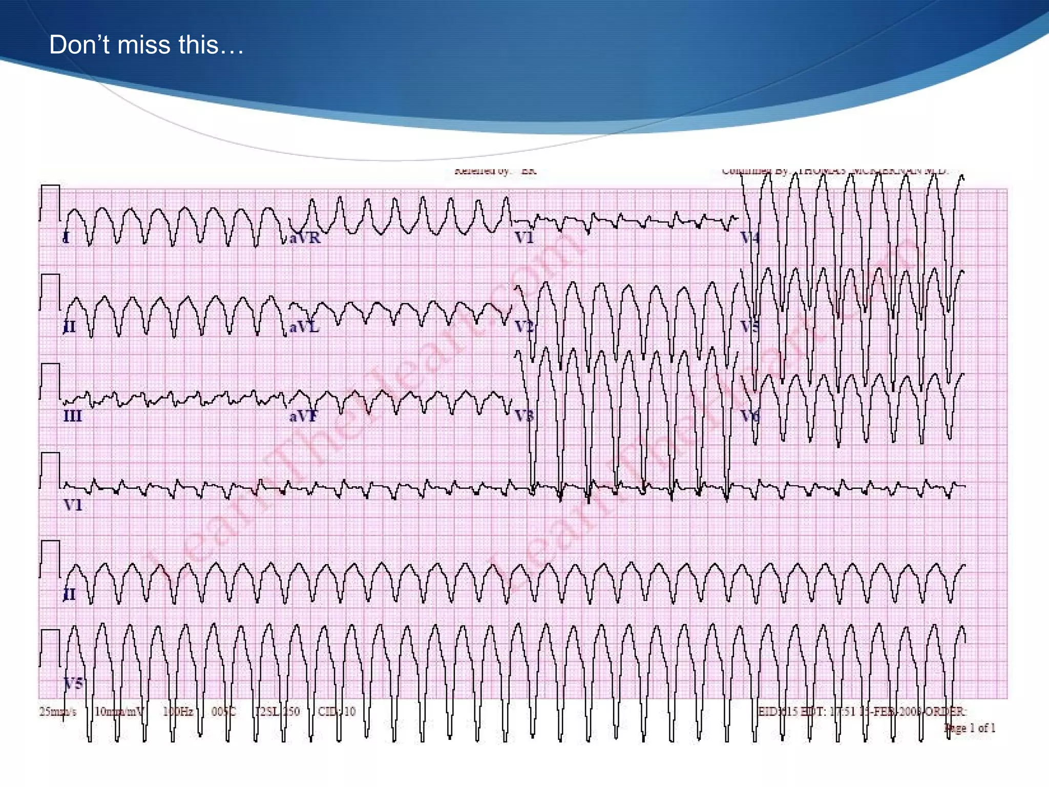Principles of ECG Interpretation | PPT | Heart and Cardiovascular ...