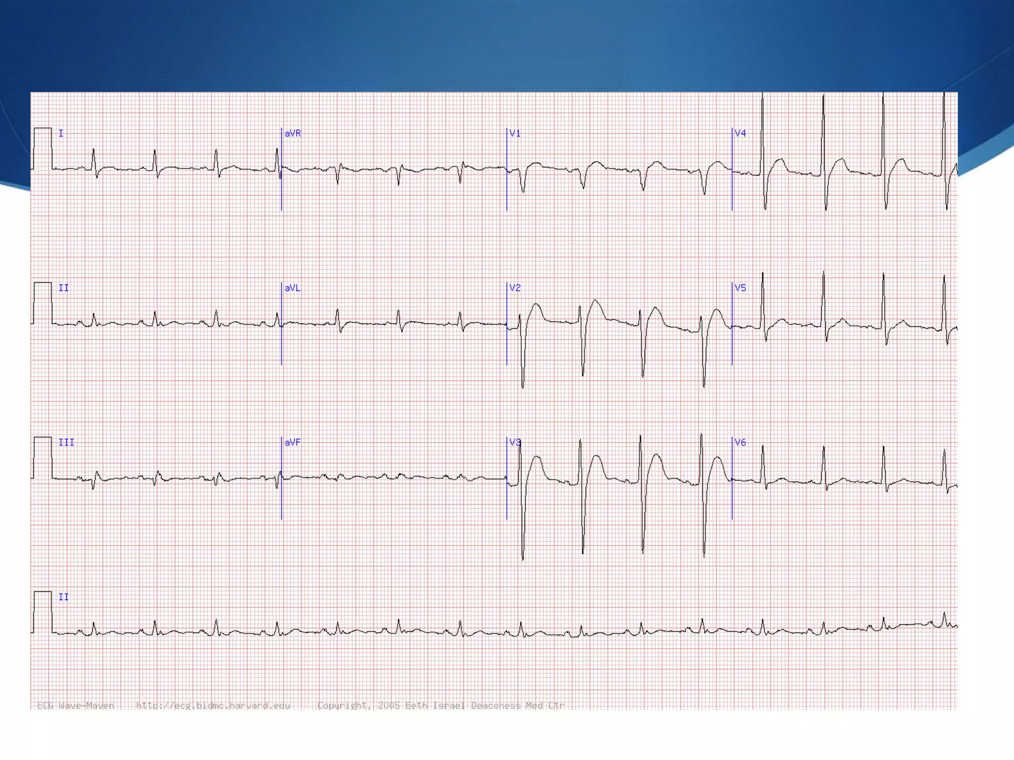 Principles of ECG Interpretation | PPT | Heart and Cardiovascular ...