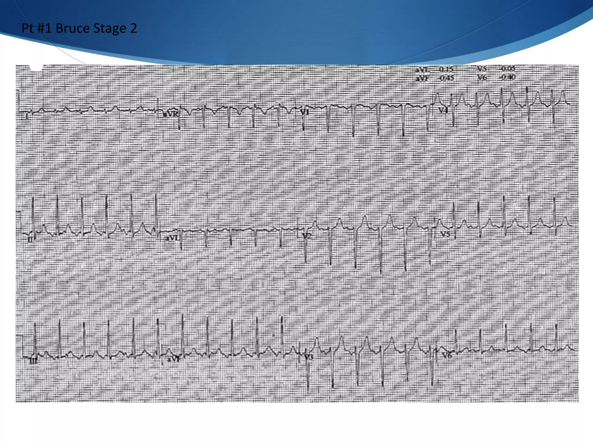 Principles of ECG Interpretation | PPT | Heart and Cardiovascular ...