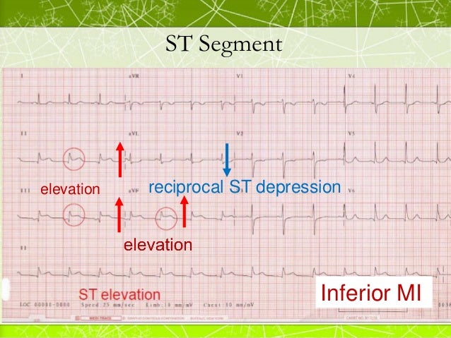 Ecg fundamentals