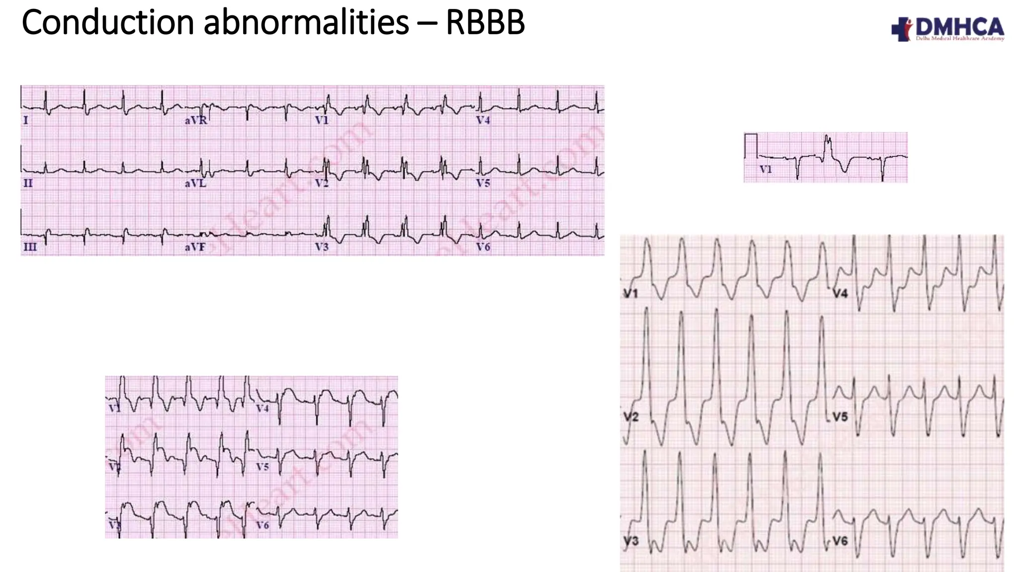 ECG Fundamentals.pptx