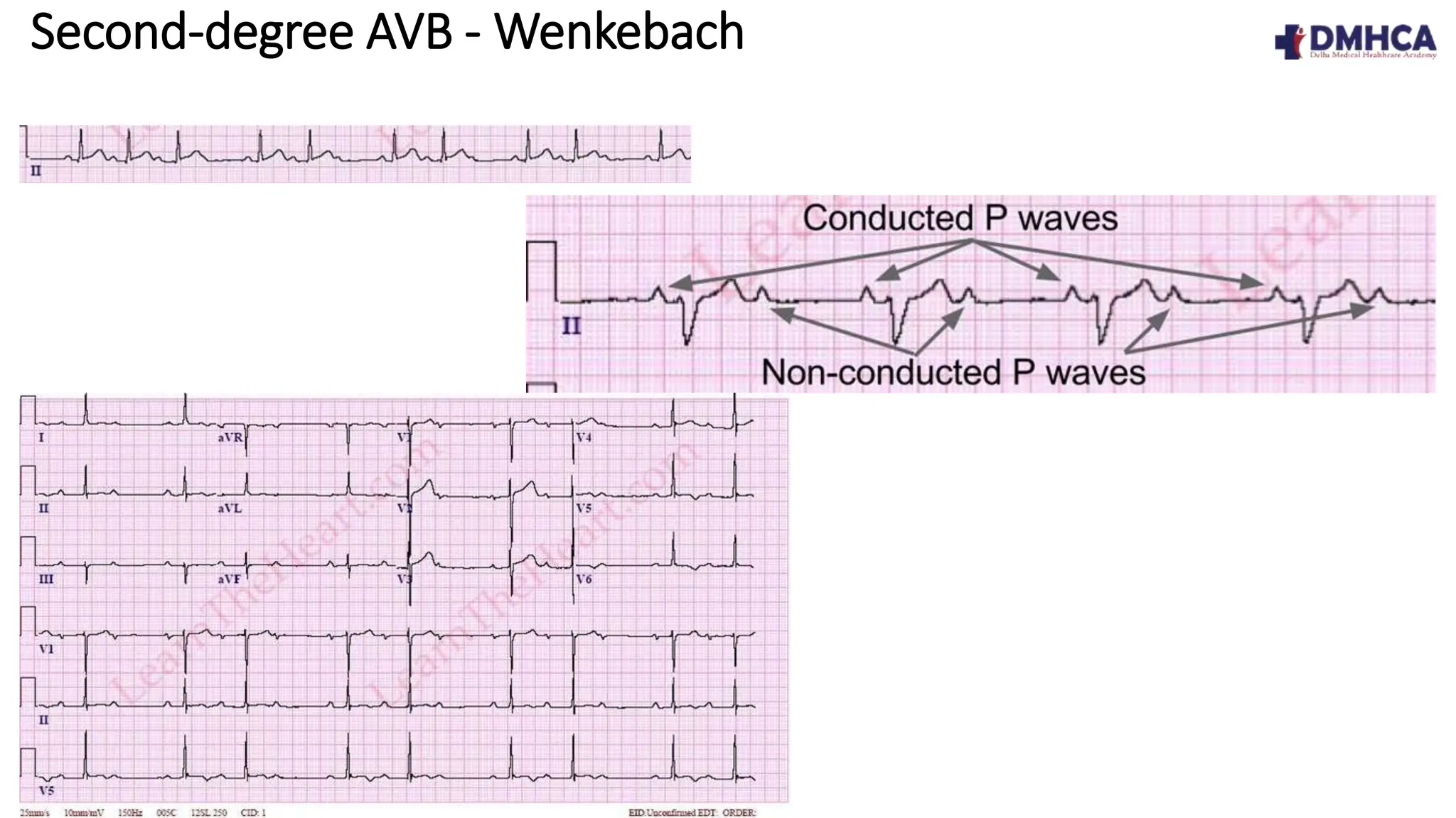 ECG Fundamentals.pptx