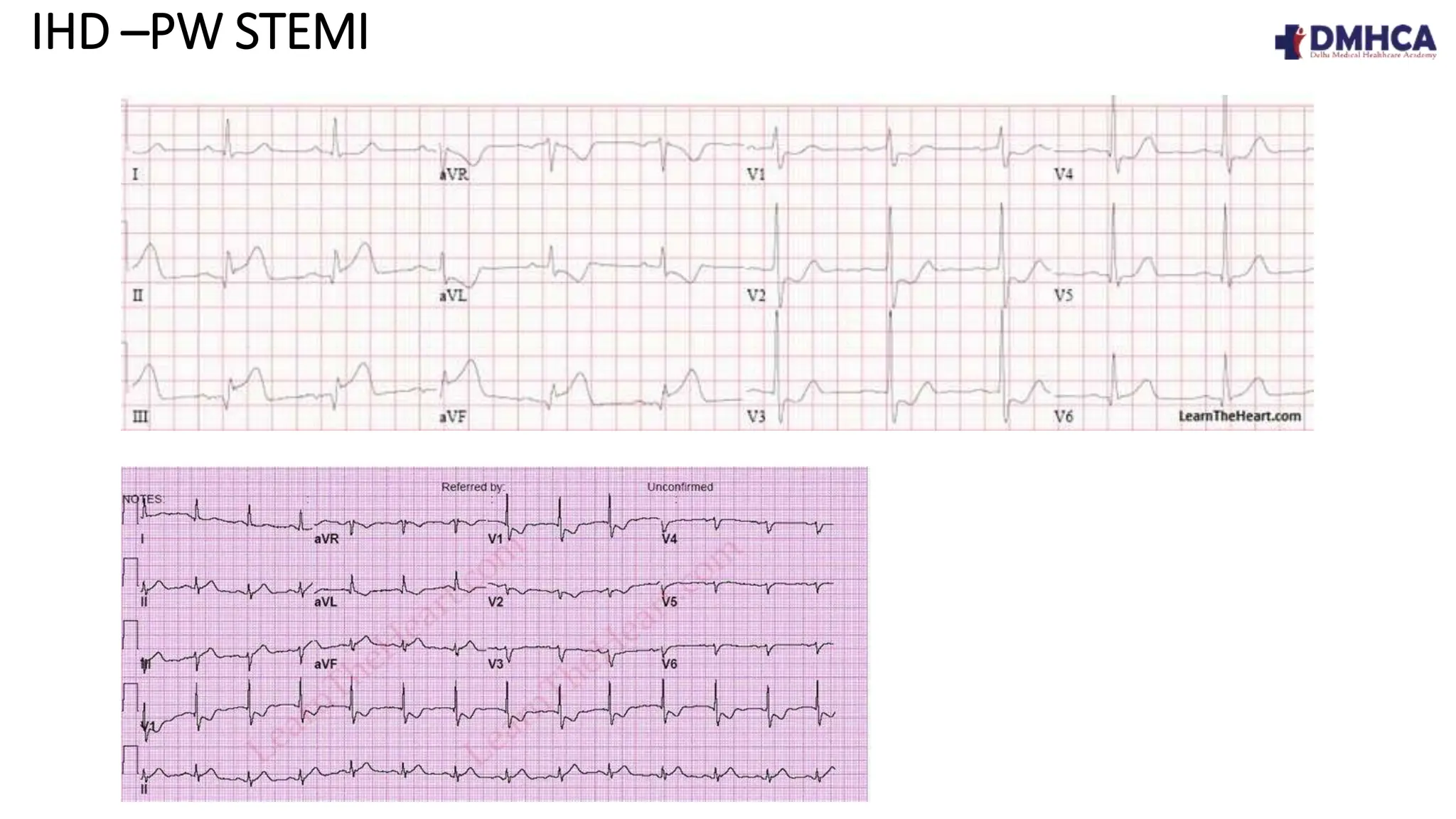 ECG Fundamentals.pptx