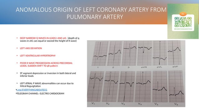 ECG learning made easy.medicine and pediatrics | PPT