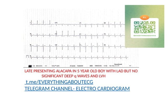ECG learning made easy.medicine and pediatrics | PPT