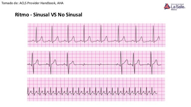 ECG Interpretación Básica