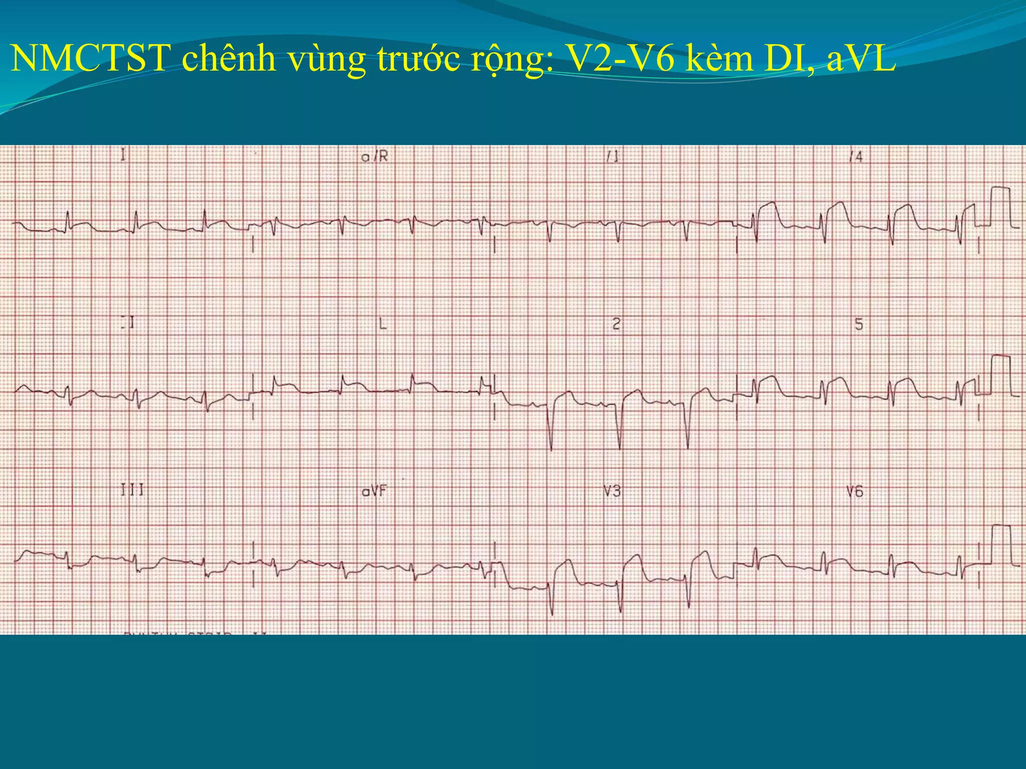 ECG hội chứng vành cấp - 2.pptx