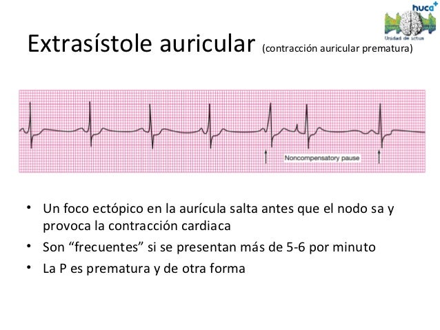 ECG HUCA