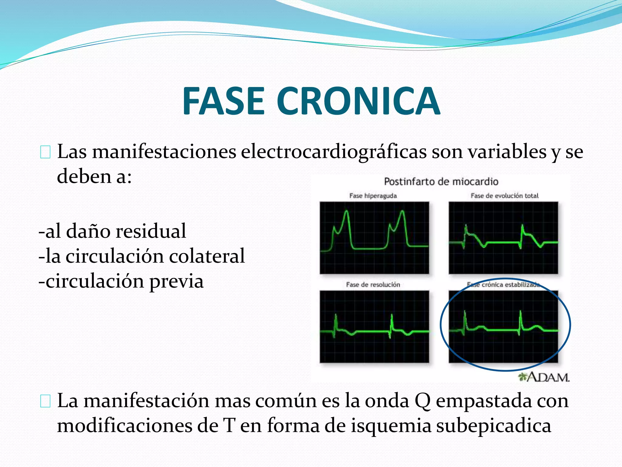 Electrocardiograma (ECG) en Infarto de Miocardio (IAM) - Dr. Bosio | PPTX