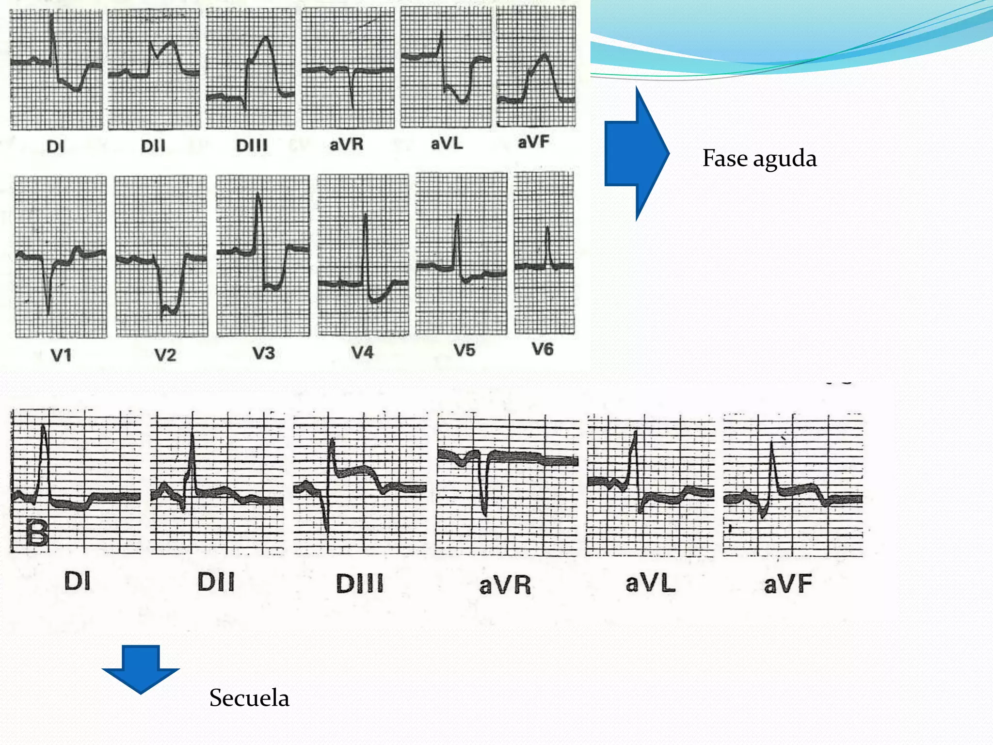 Electrocardiograma (ECG) en Infarto de Miocardio (IAM) - Dr. Bosio | PPTX