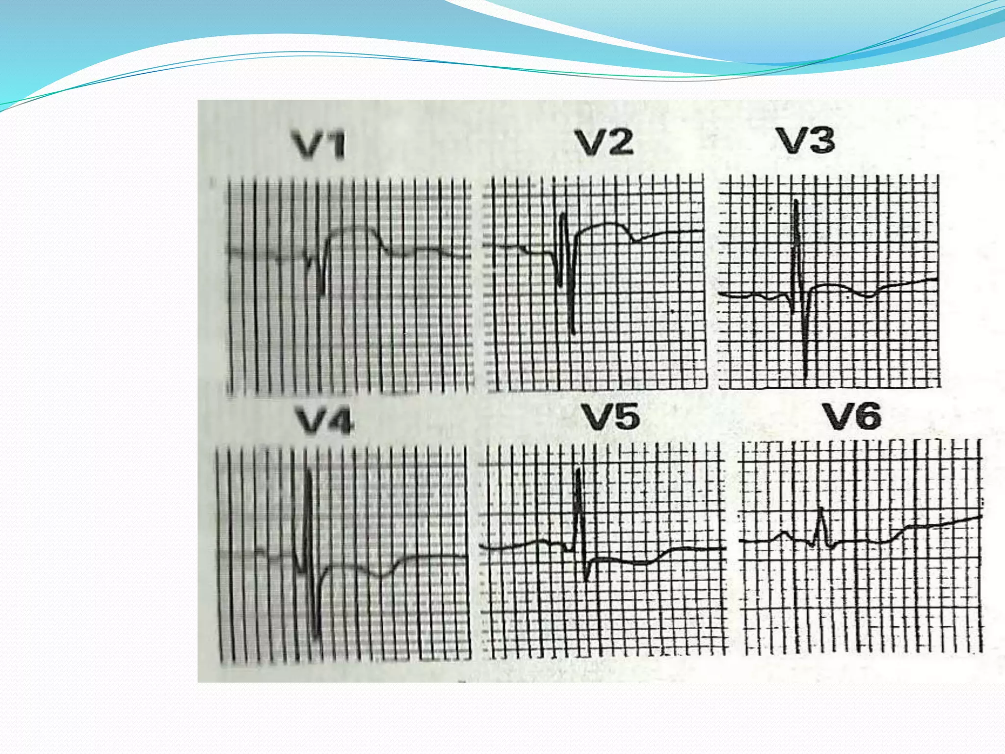 Electrocardiograma (ECG) en Infarto de Miocardio (IAM) - Dr. Bosio | PPTX