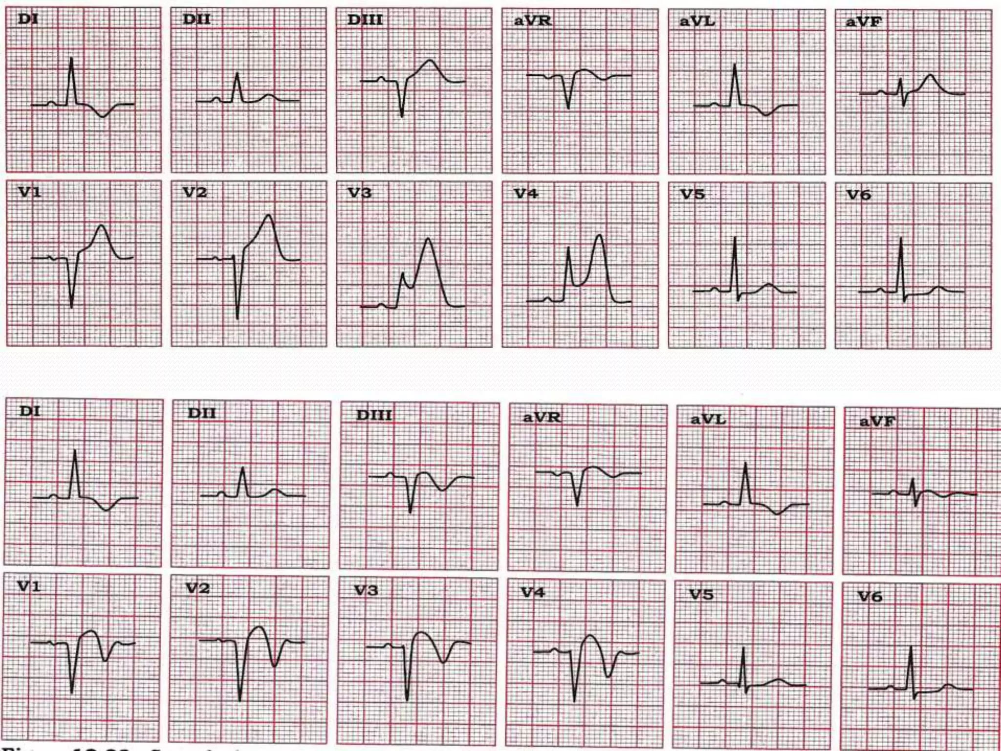 Electrocardiograma (ECG) en Infarto de Miocardio (IAM) - Dr. Bosio | PPTX