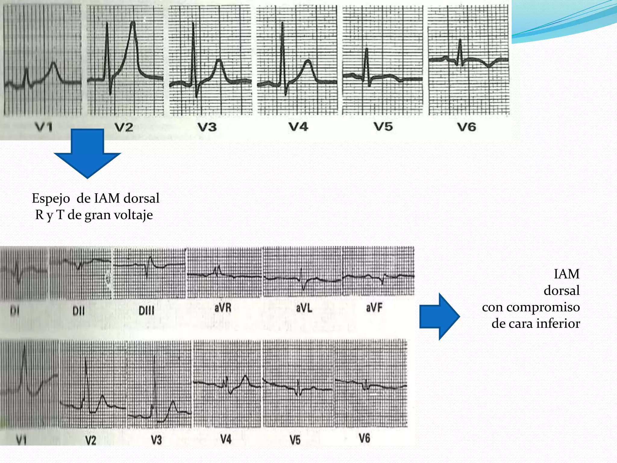 Electrocardiograma (ECG) en Infarto de Miocardio (IAM) - Dr. Bosio | PPTX