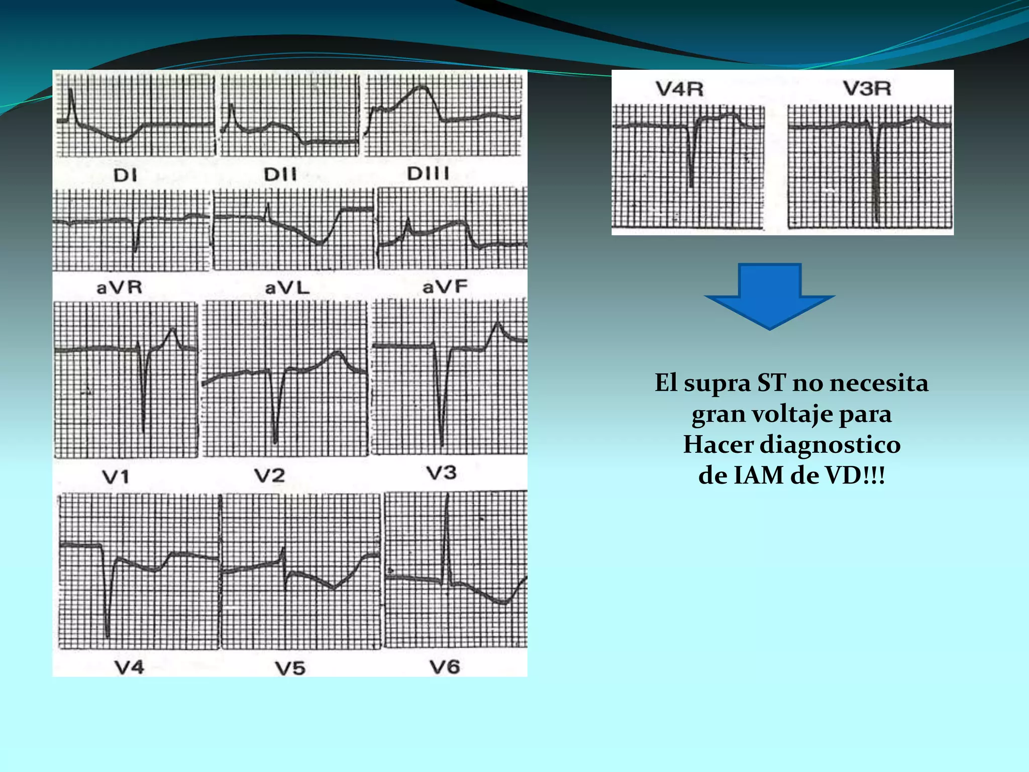 Electrocardiograma (ECG) en Infarto de Miocardio (IAM) - Dr. Bosio | PPTX