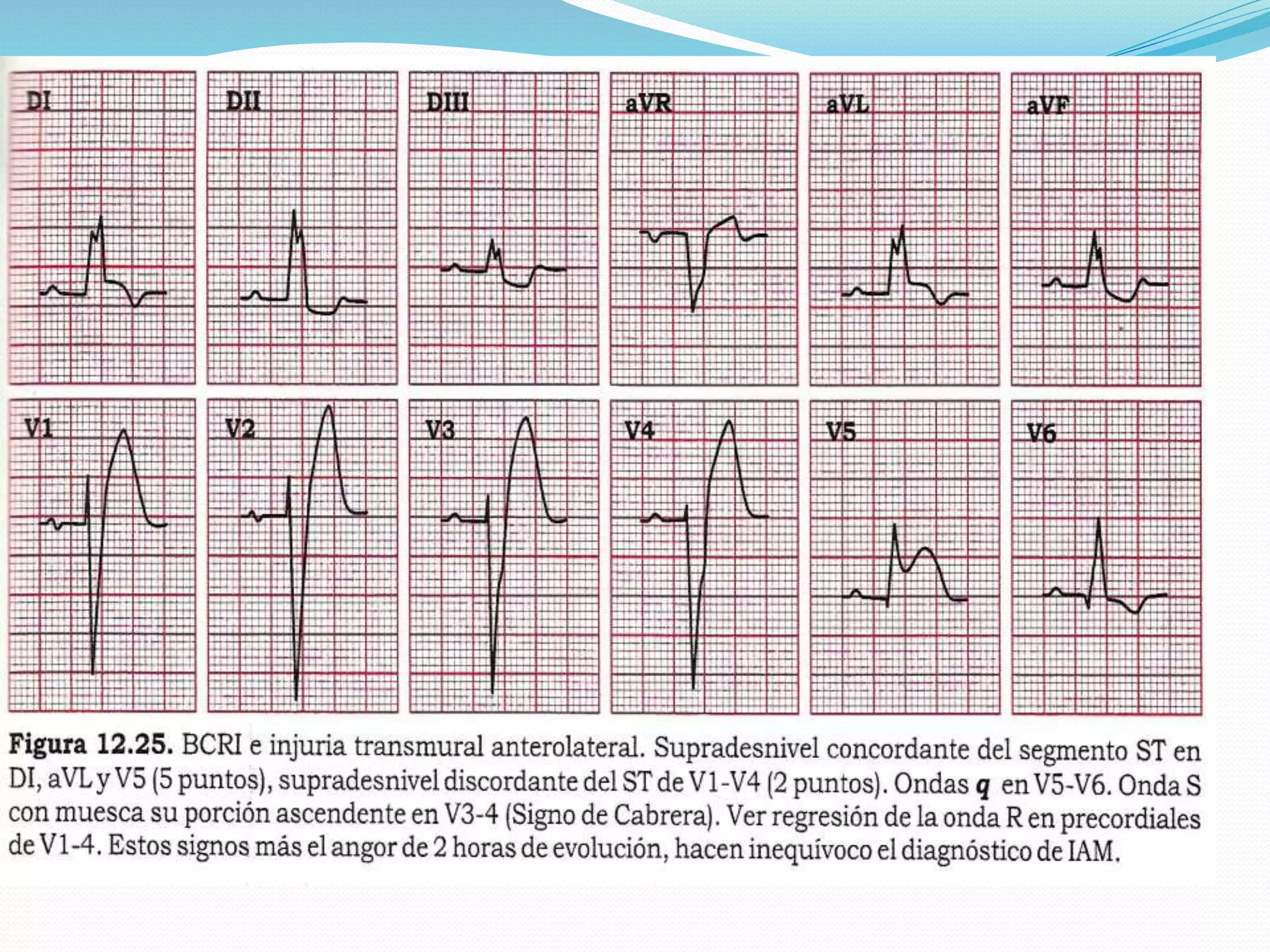Electrocardiograma (ECG) en Infarto de Miocardio (IAM) - Dr. Bosio | PPTX