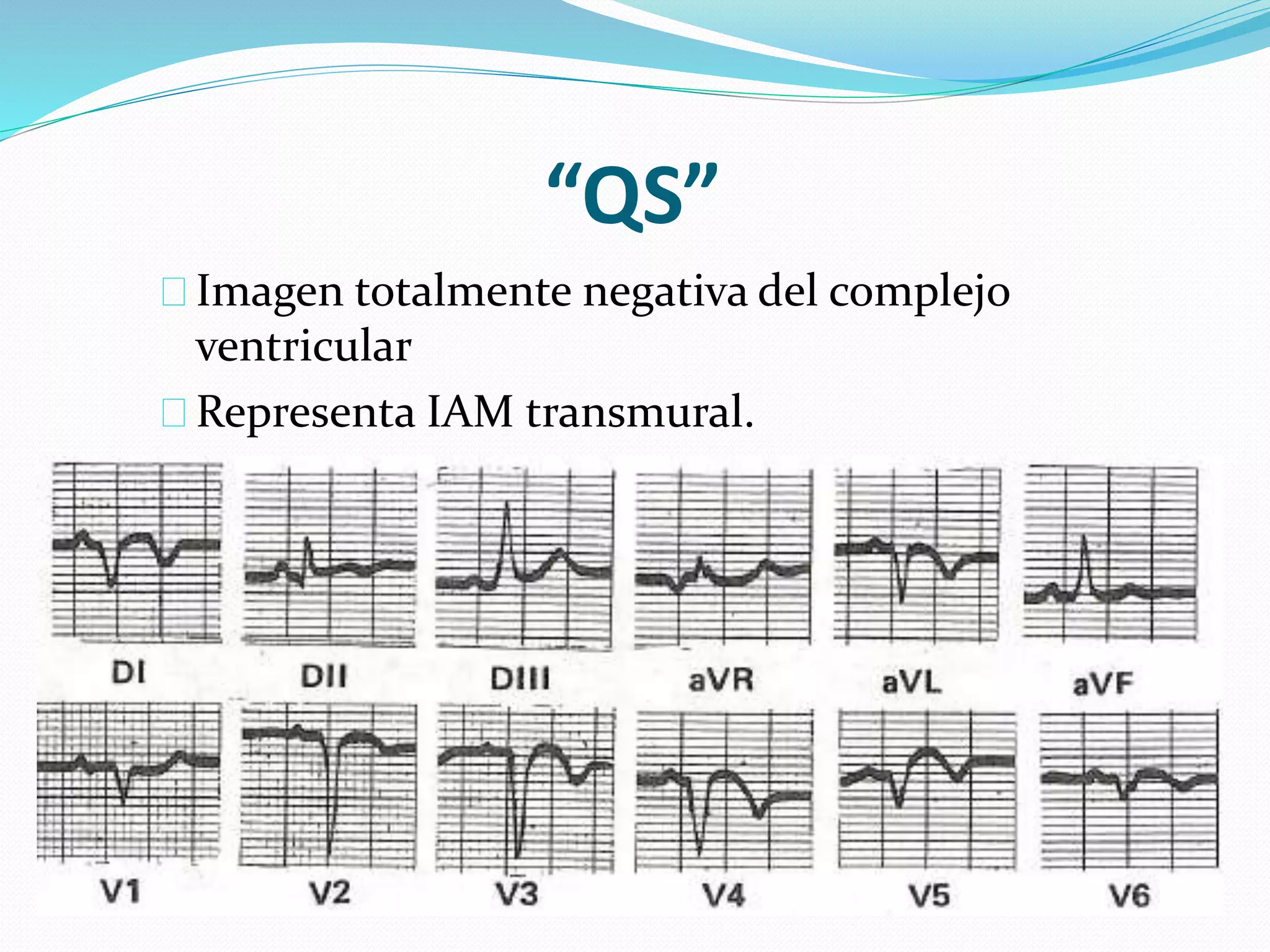 Electrocardiograma (ECG) en Infarto de Miocardio (IAM) - Dr. Bosio | PPTX