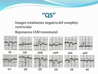 Electrocardiograma (ECG) en Infarto de Miocardio (IAM) - Dr. Bosio | PPTX