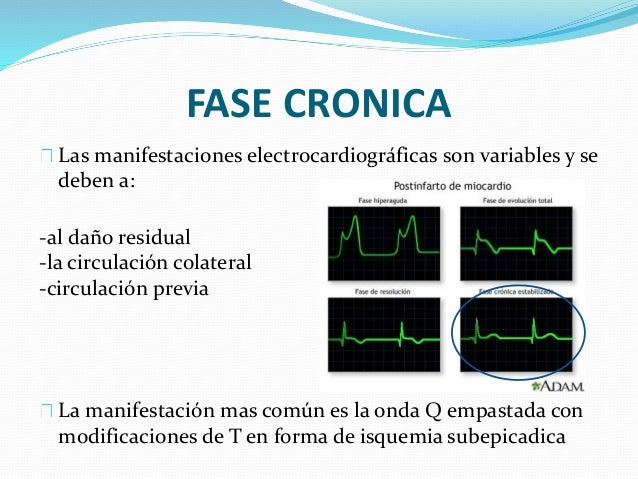 Electrocardiograma Ecg En Infarto De Miocardio Iam