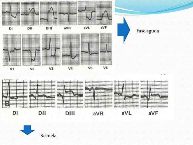 Electrocardiograma Ecg En Infarto De Miocardio Iam