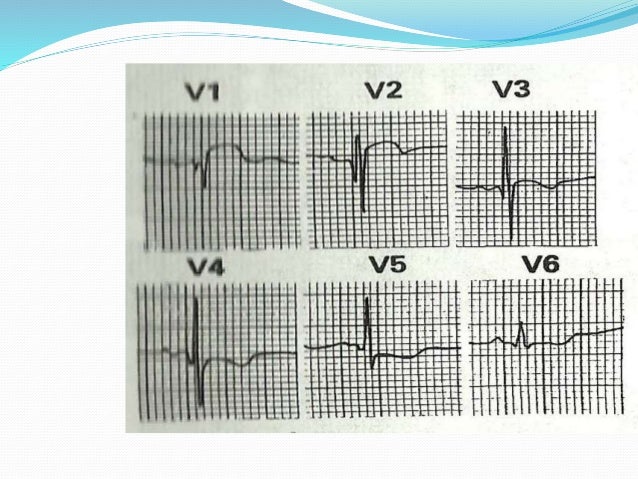 Electrocardiograma Ecg En Infarto De Miocardio Iam