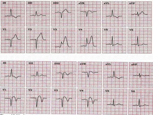 Electrocardiograma (ECG) en Infarto de Miocardio (IAM) - Dr. Bosio