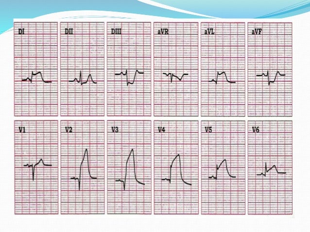 Electrocardiograma Ecg En Infarto De Miocardio Iam