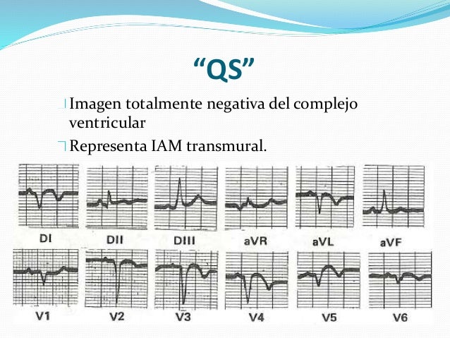 Electrocardiograma (ECG) en Infarto de Miocardio (IAM) - Dr. Bosio