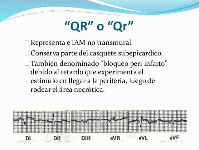 Electrocardiograma Ecg En Infarto De Miocardio Iam