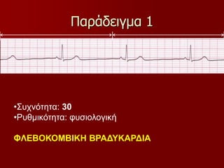 Εισαγωγή στο ΗΚΓ | PPT
