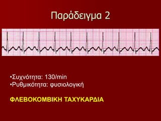 Εισαγωγή στο ΗΚΓ | PPTX