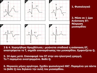 Εισαγωγή στο ΗΚΓ | PPTX