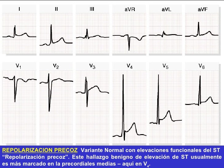 Ecg Ii Isquemia