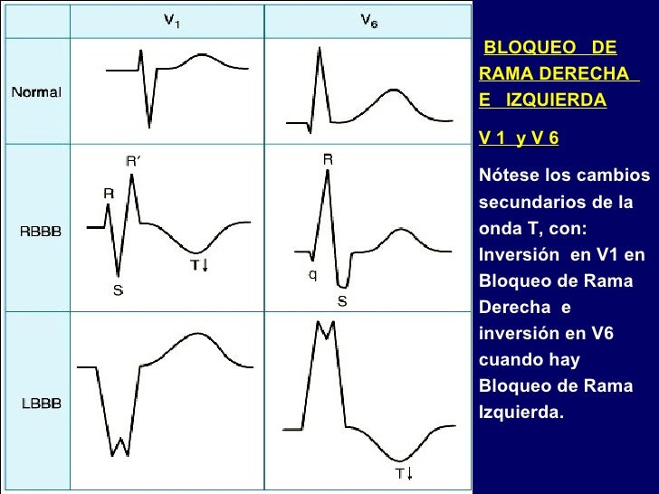 Ecg Ii Isquemia